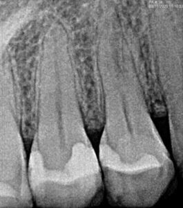 Zarc4Endo | Advantages of using BlueShaper on tooth with three canals