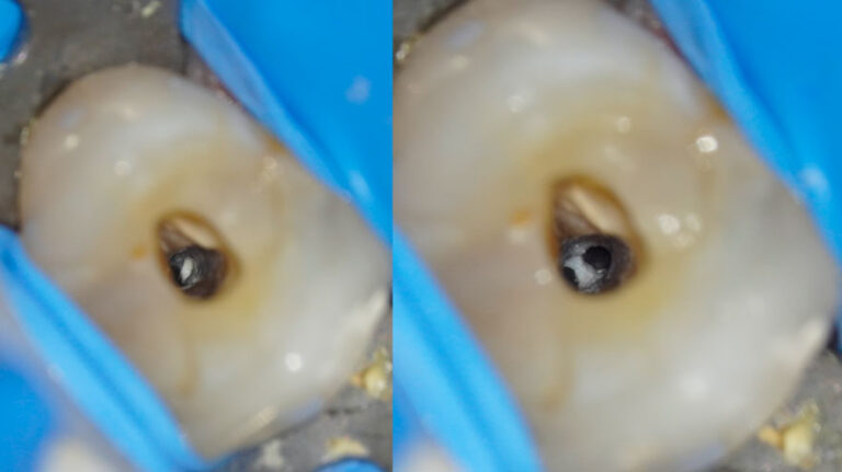 Zarc4Endo | Advantages of using BlueShaper on tooth with three canals