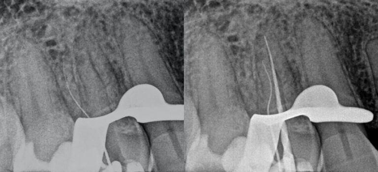 Zarc4Endo | Advantages of using BlueShaper on tooth with three canals