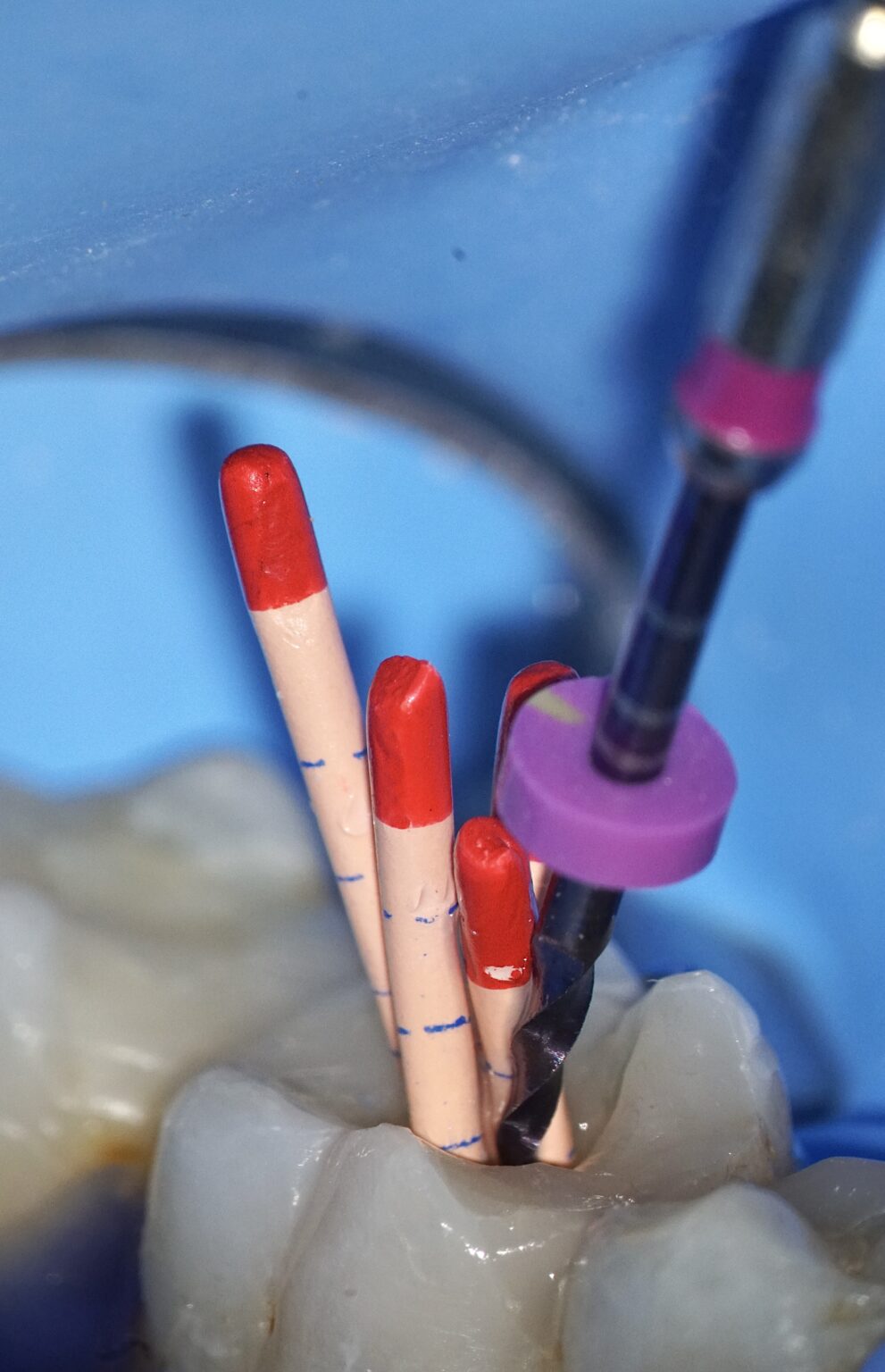 Endodoncia en diente 4.6 con lima fracturada