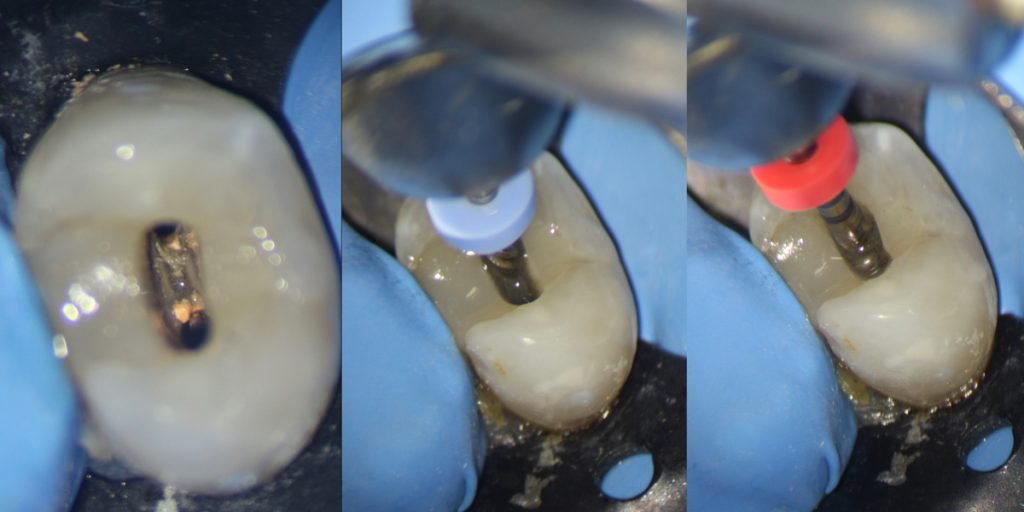 Reendodoncia utilizando limas RetreatAll® y Z-Activator®.