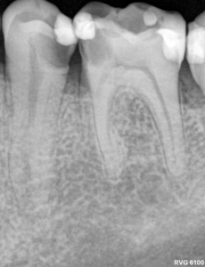 Zarc4Endo | Endodoncia utilizando limas SlimShaper® y Z-Activator®.