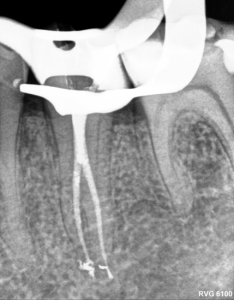 Zarc4Endo | Endodoncia utilizando limas SlimShaper® y Z-Activator®.