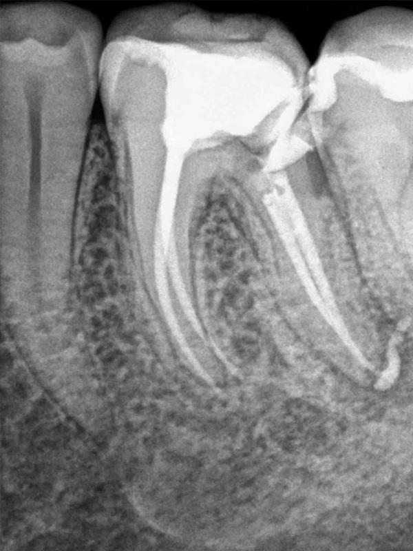 NeoSealer Flo | Zarc4Endo