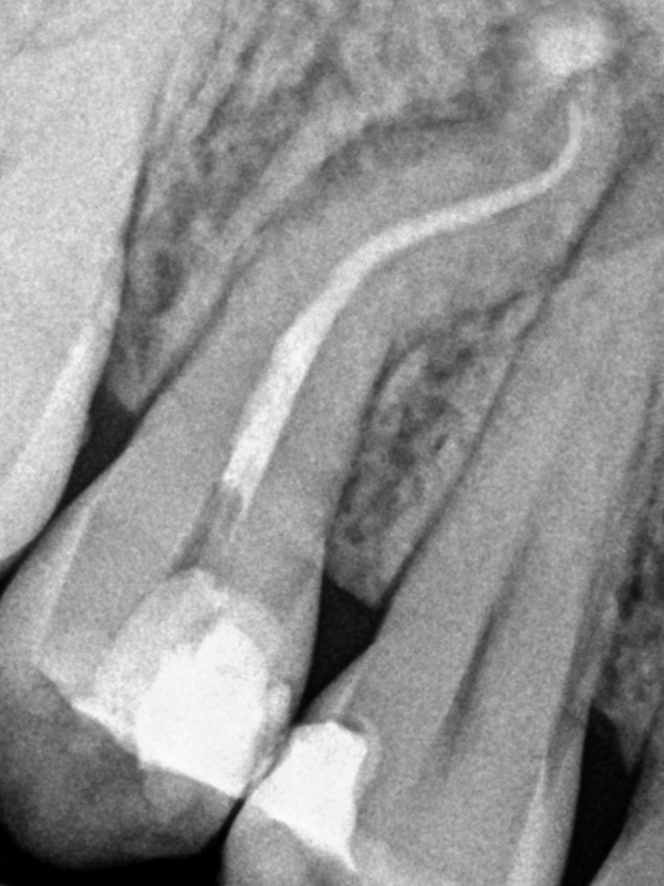 NeoSealer Flo | Zarc4Endo