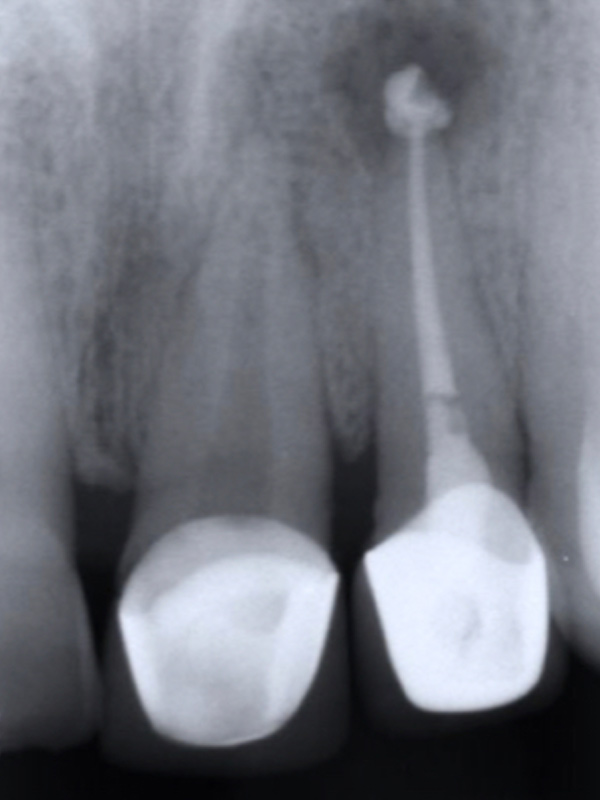 NeoSealer Flo | Zarc4Endo