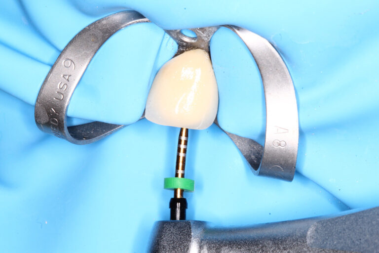 Zarc | Retreatment sealed with NeoSealer Flo®