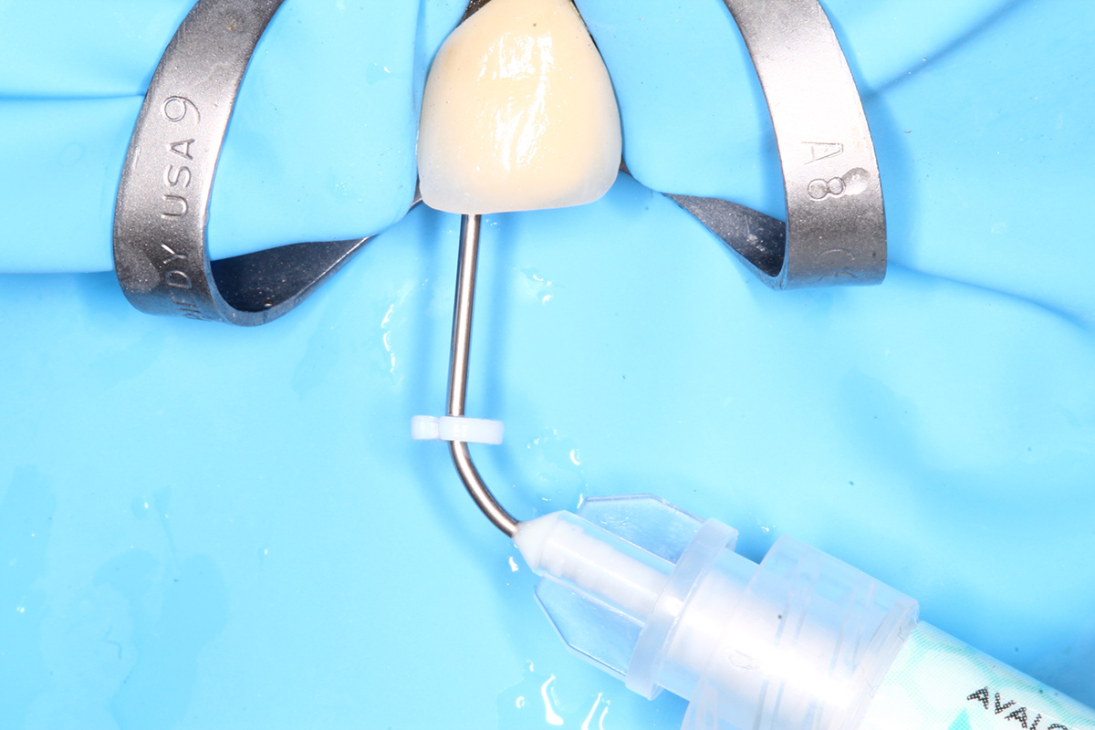 Zarc | Retreatment sealed with NeoSealer Flo®