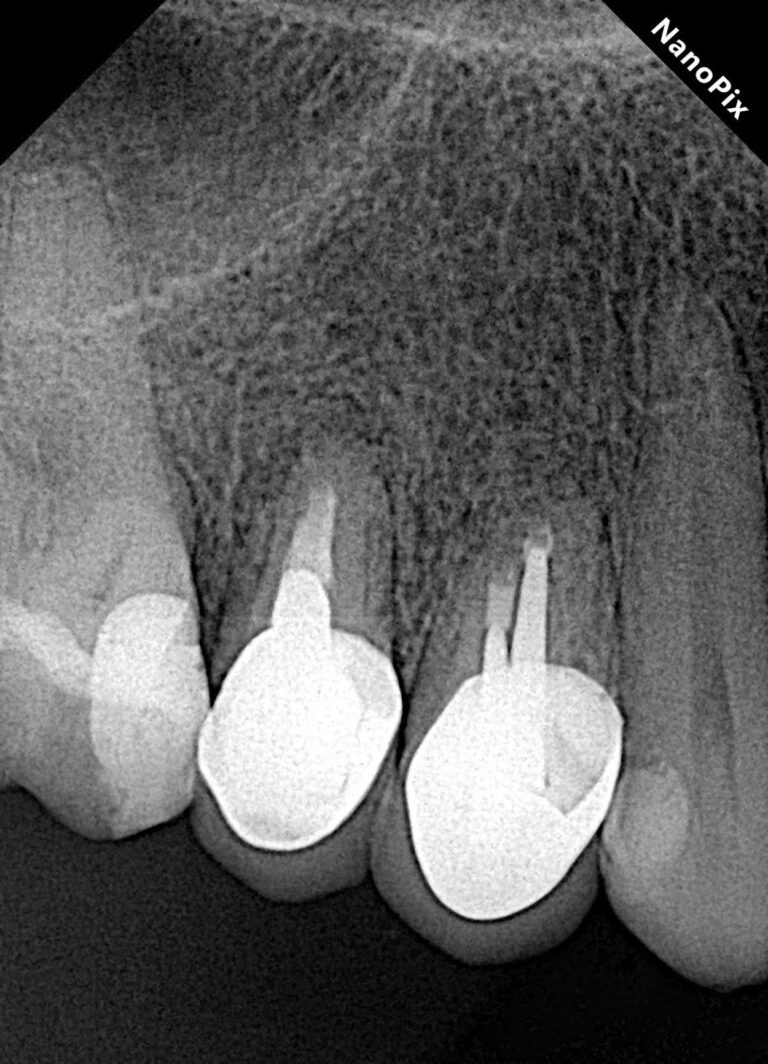 NEOPUTTY | CASO CLÍNICO | CIRUGÍA PARAENDODÓNTICA