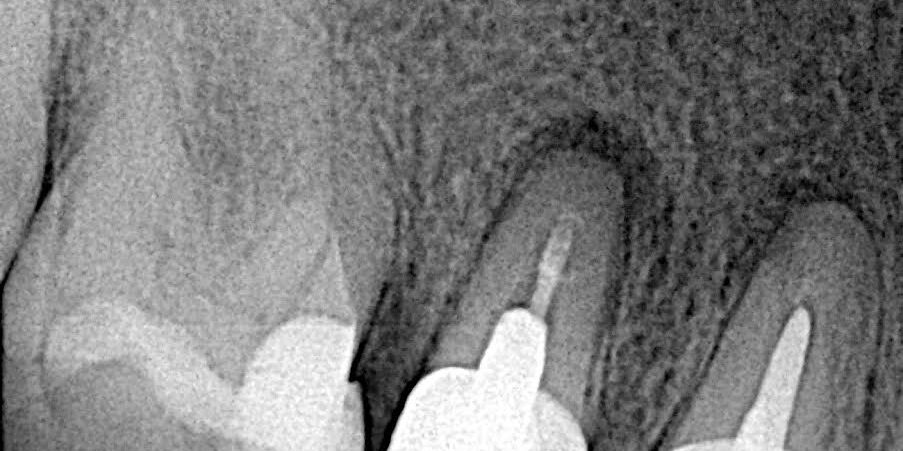NeoPutty | Endodontic Surgery with Retrograde