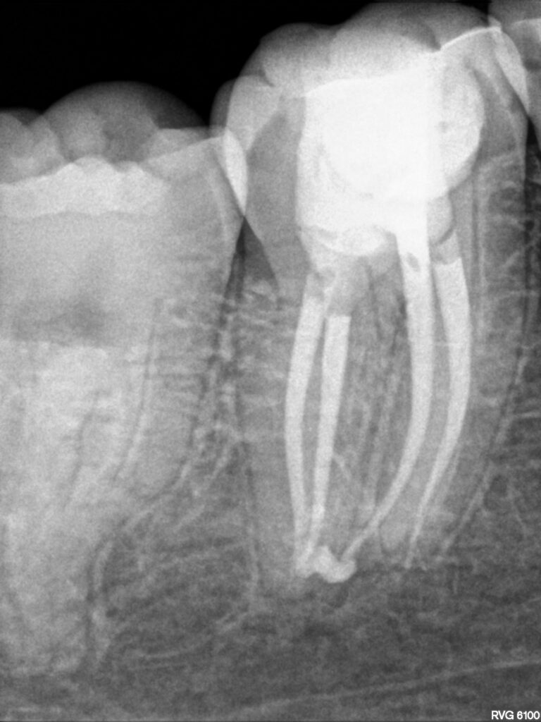 Sistema BlueShaper PRO® | Zarc4endo