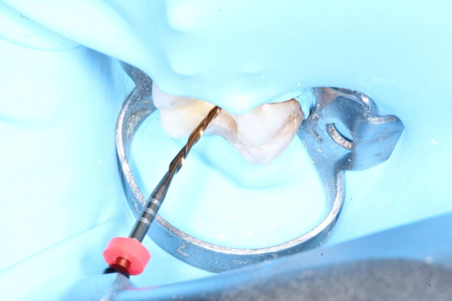 Clinical Case Retreatment Noe Hernández | Excalibur System