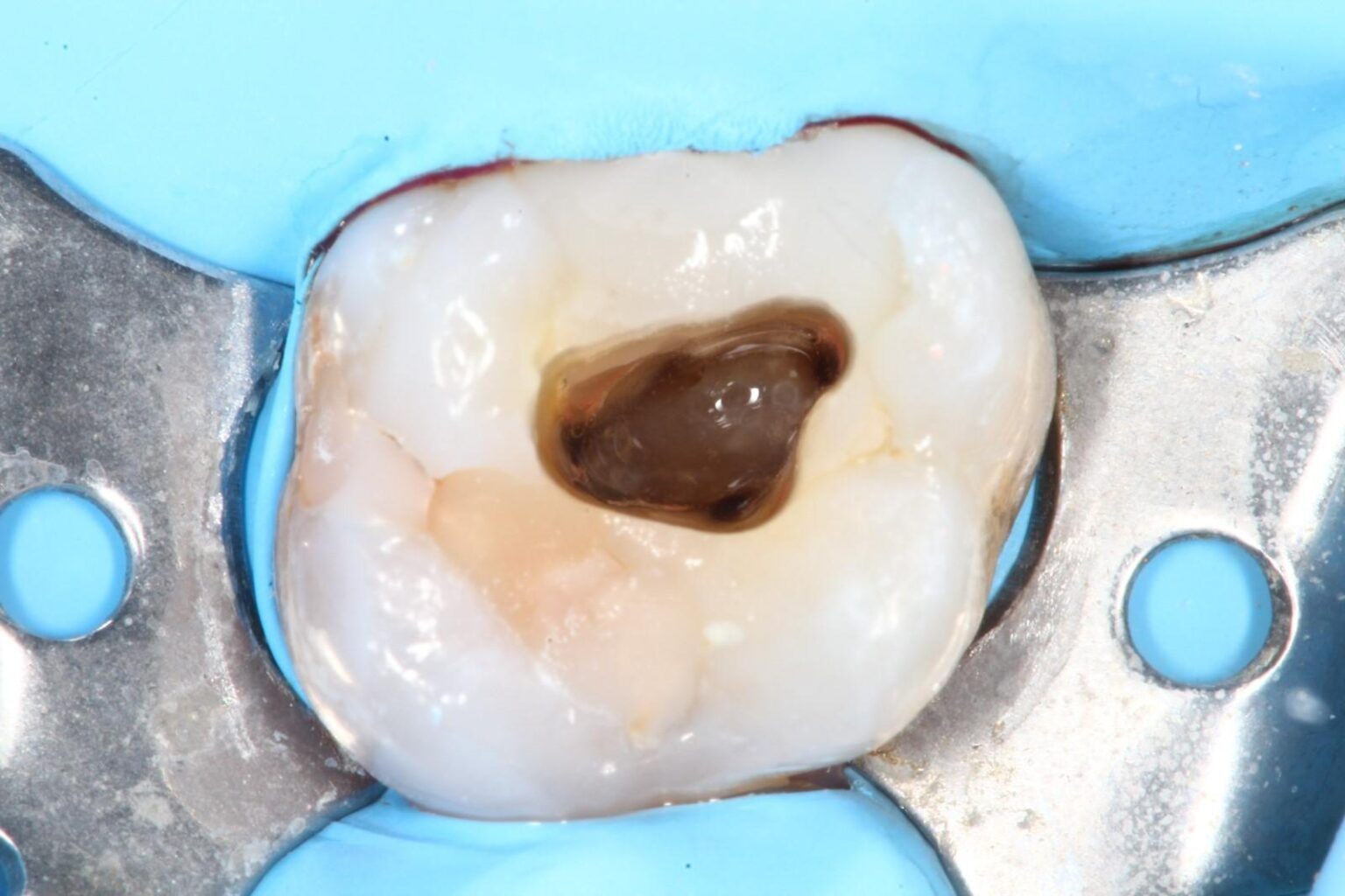 Clinical Case Retreatment Noe Hernández | Excalibur System