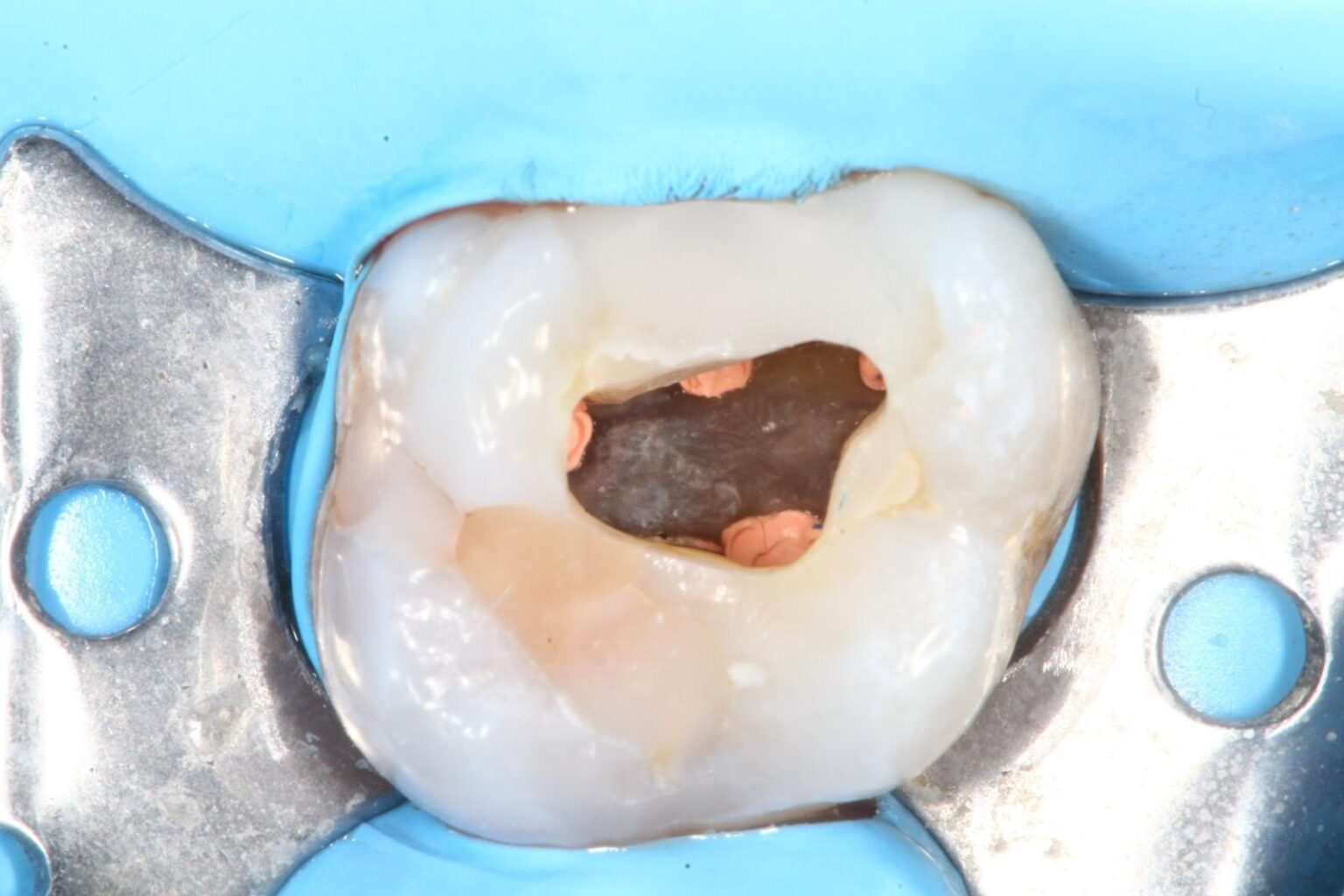 Clinical Case Retreatment Noe Hernández | Excalibur System