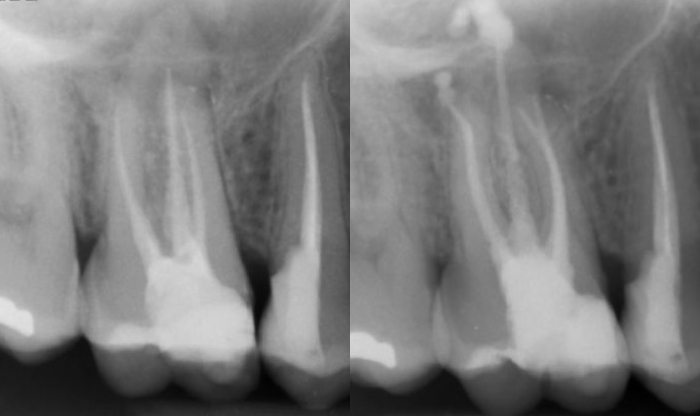 Clinical Case Retreatment Noe Hernández | Excalibur System